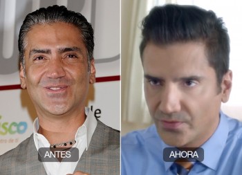 Alejandro Fernandez Cirugia Antes Y Despues