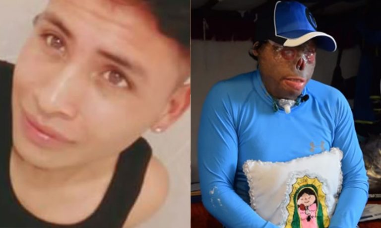 #Video Chavo Michoacano Pide Ayuda A AMLO Para Trasplante De Rostro ...