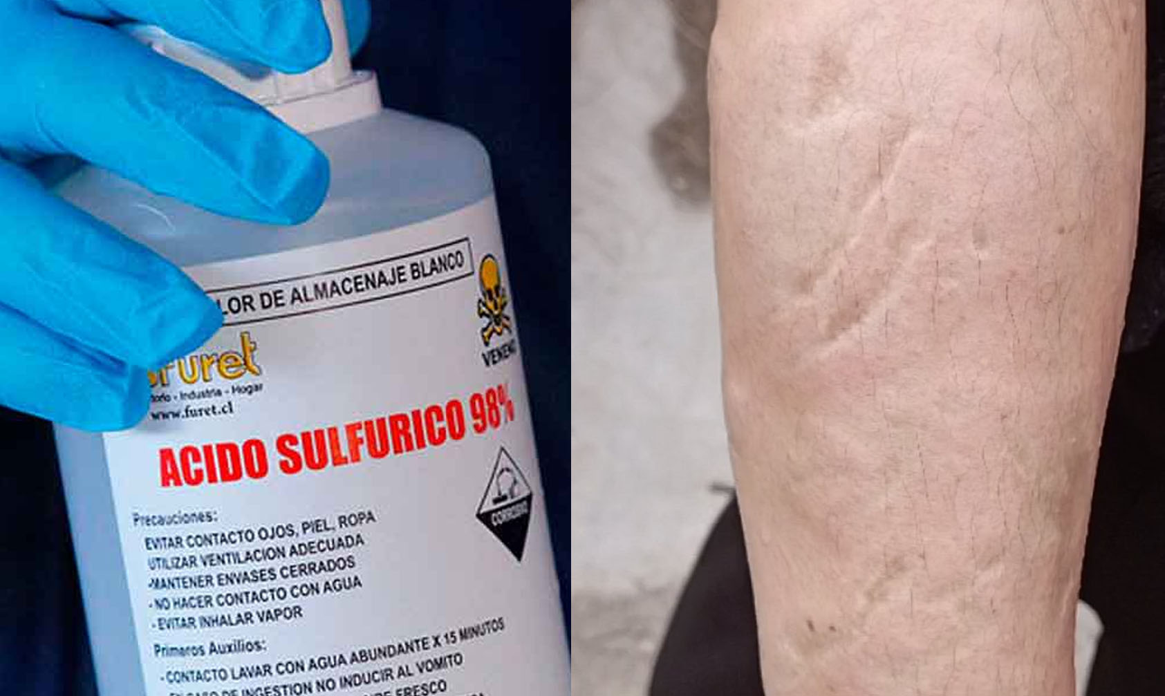 Pasa En Puebla: Atacan Con Ácido A Mujer En La Calle; Le Gritaron ...